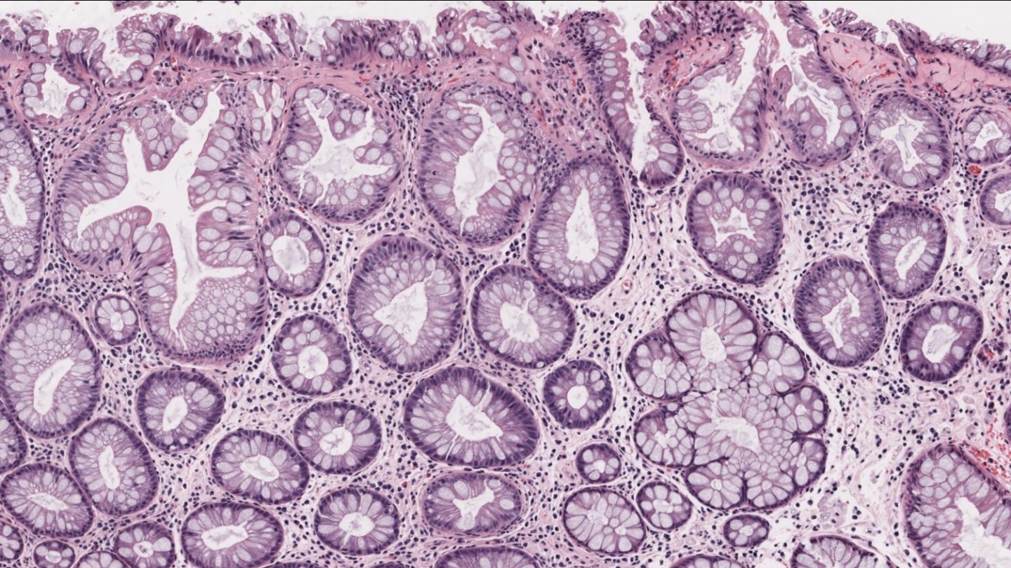 Gastrointestinal and Liver Pathology | Pathology Residency | Medical ...