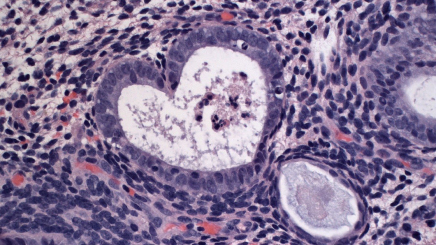 Women’s Pathology (Gynecologic, Breast, and Cytopathology) | Pathology ...