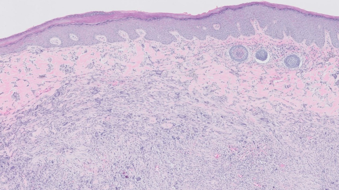 Slide Box - Dermatopathology & Soft Tissue 2 | Pathology Residency ...